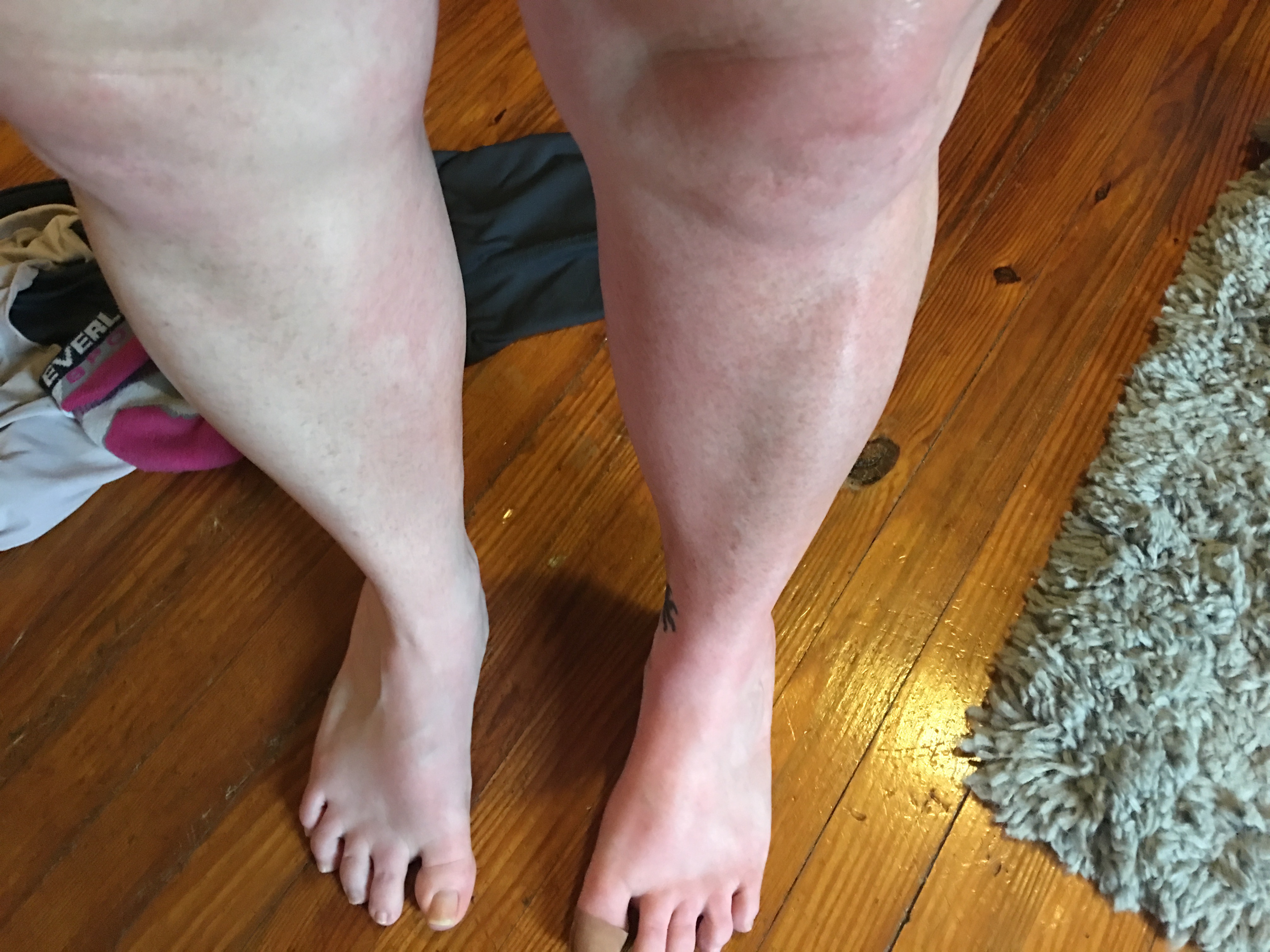 Physical Therapy & Complex Regional Pain Syndrome (CRPS): a guide for ...